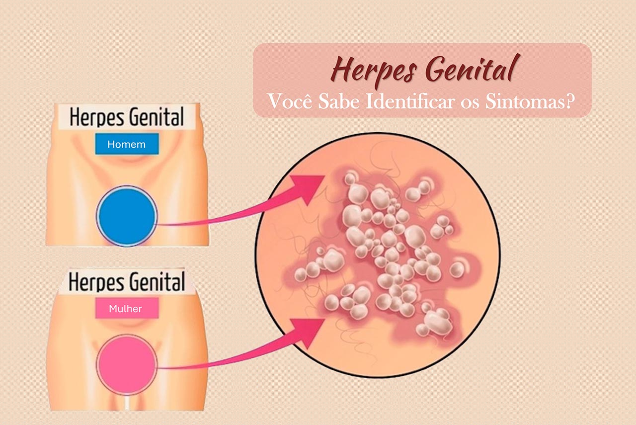 Herpes Genital: Você Sabe Identificar os Sintomas? - Dra. Judith Pim